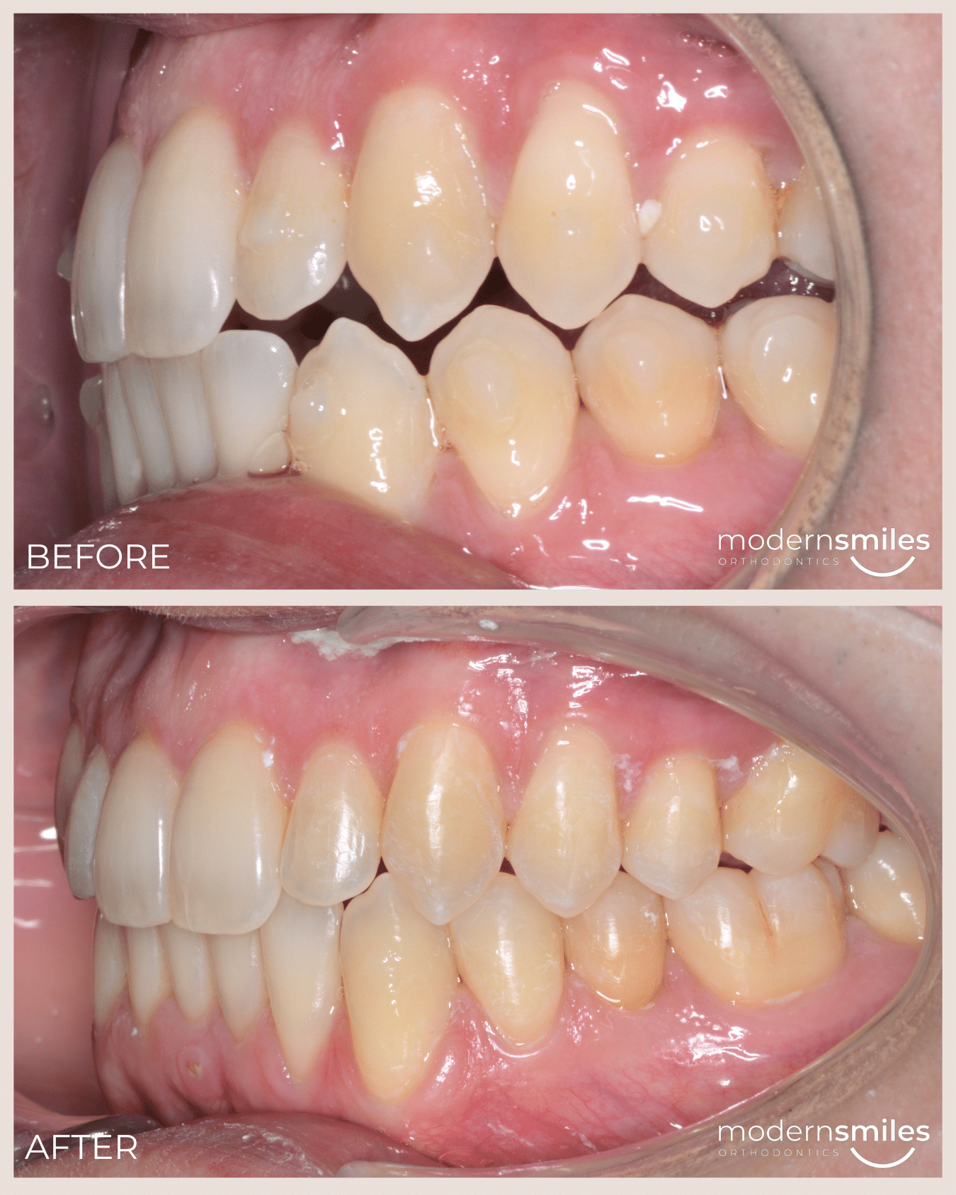 Before and after treatment at Modern Smiles Orthodontics