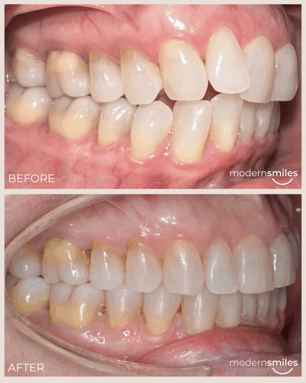 Before and after treatment at Modern Smiles Orthodontics