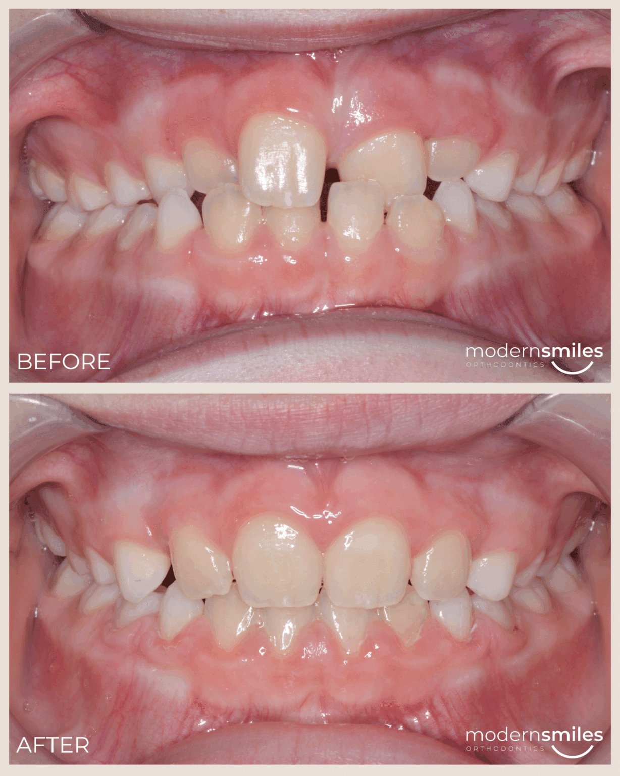 Before and after treatment at Modern Smiles Orthodontics